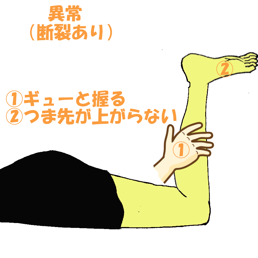 かんたんーアキレス腱断裂 - いい医者.com